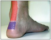 Achillespees blessure? Pijn aan de achillespees? Klachten?