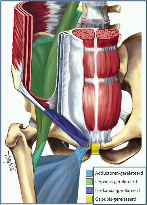 Liesblessure? Last van een lies blessure? Klachten?